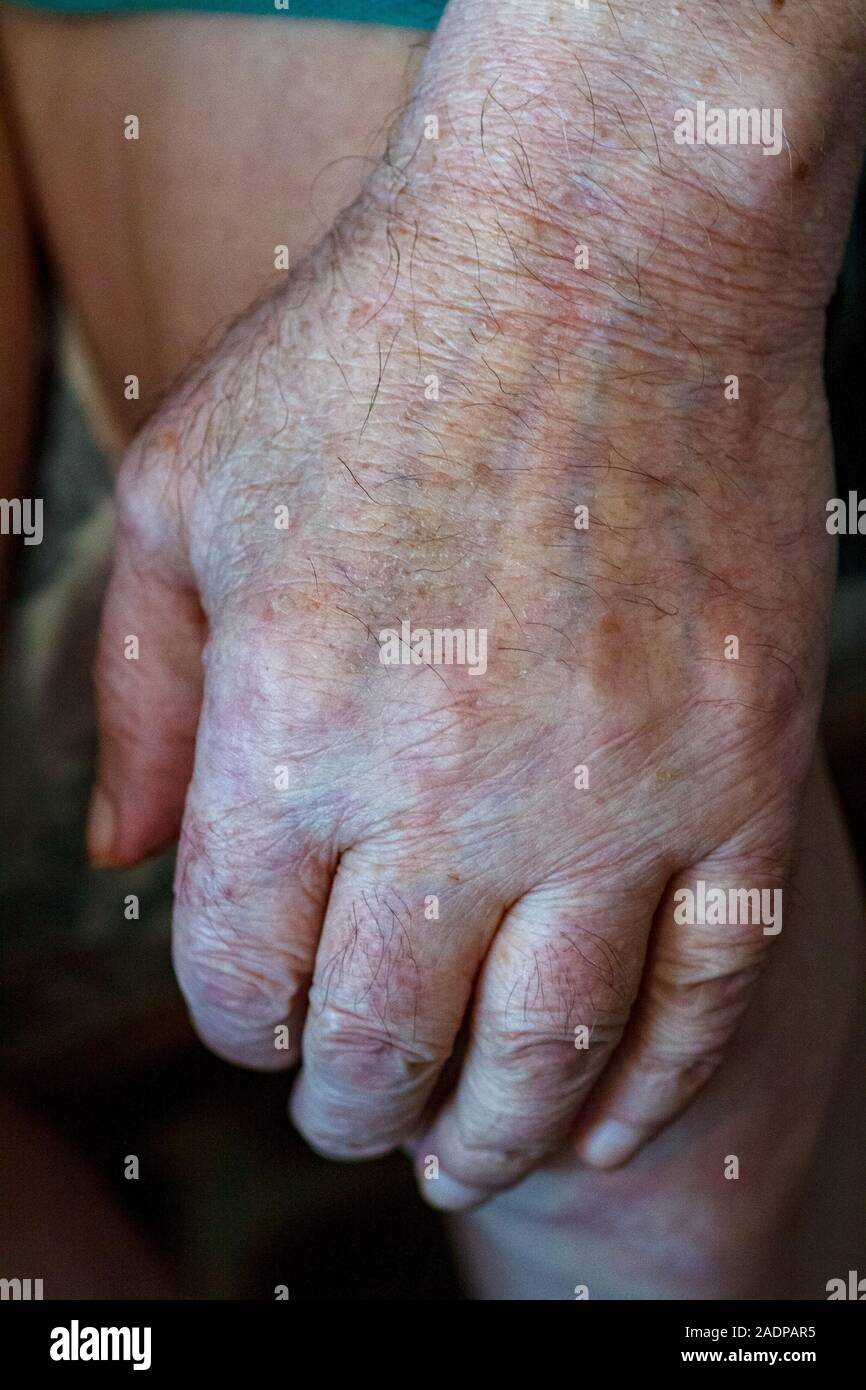 The process of aging of human skin - wrinkled hands of a very old man ...