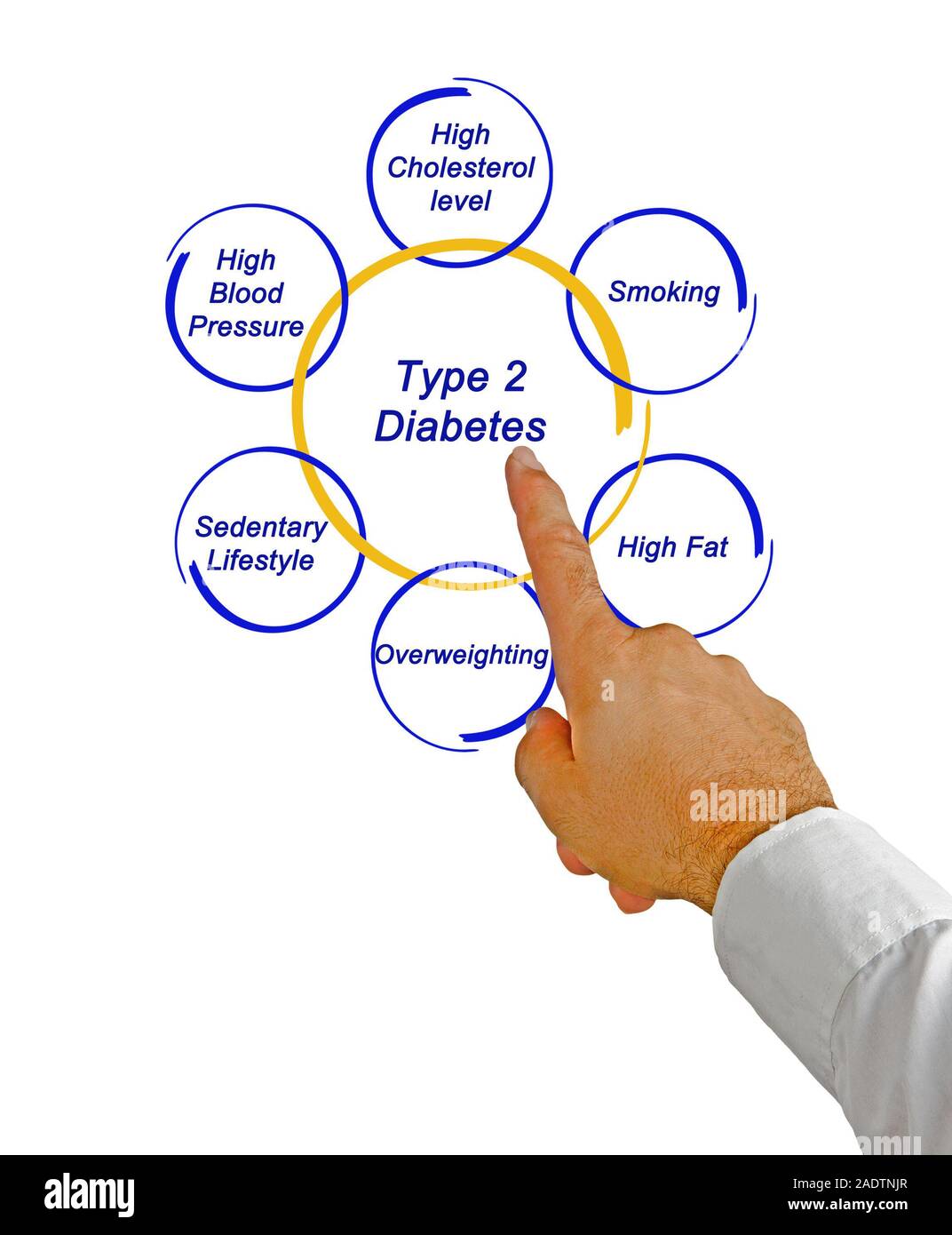 Type 2 diabetes diagram hi-res stock photography and images - Alamy