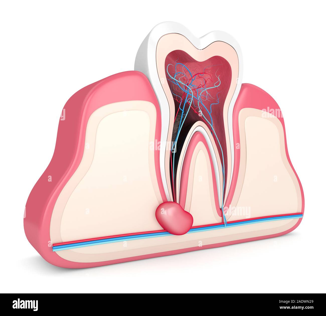 3d render of tooth in gums with cyst. Dental problem concept Stock ...