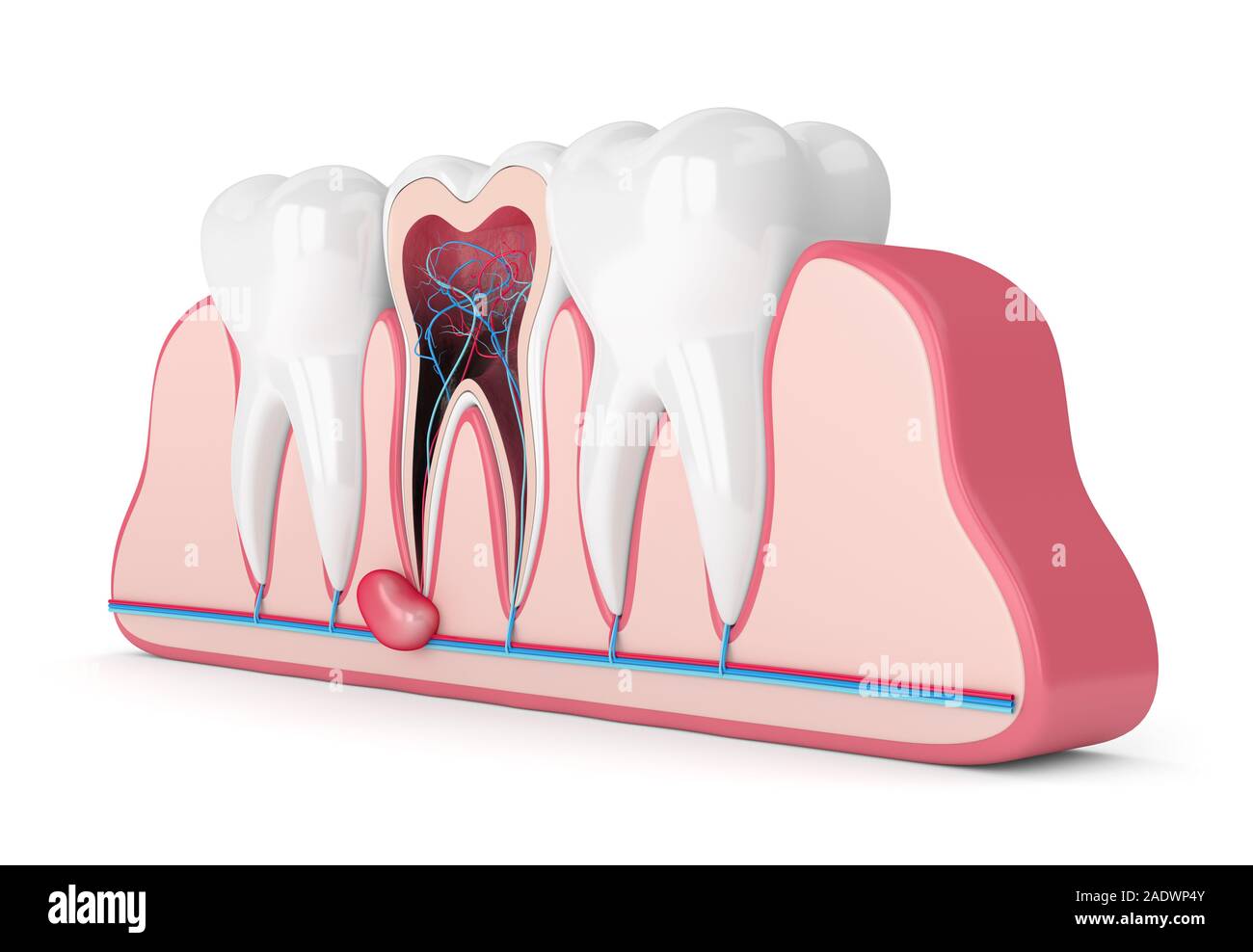 3d render of teeth in gums with cyst. Dental problem concept Stock ...