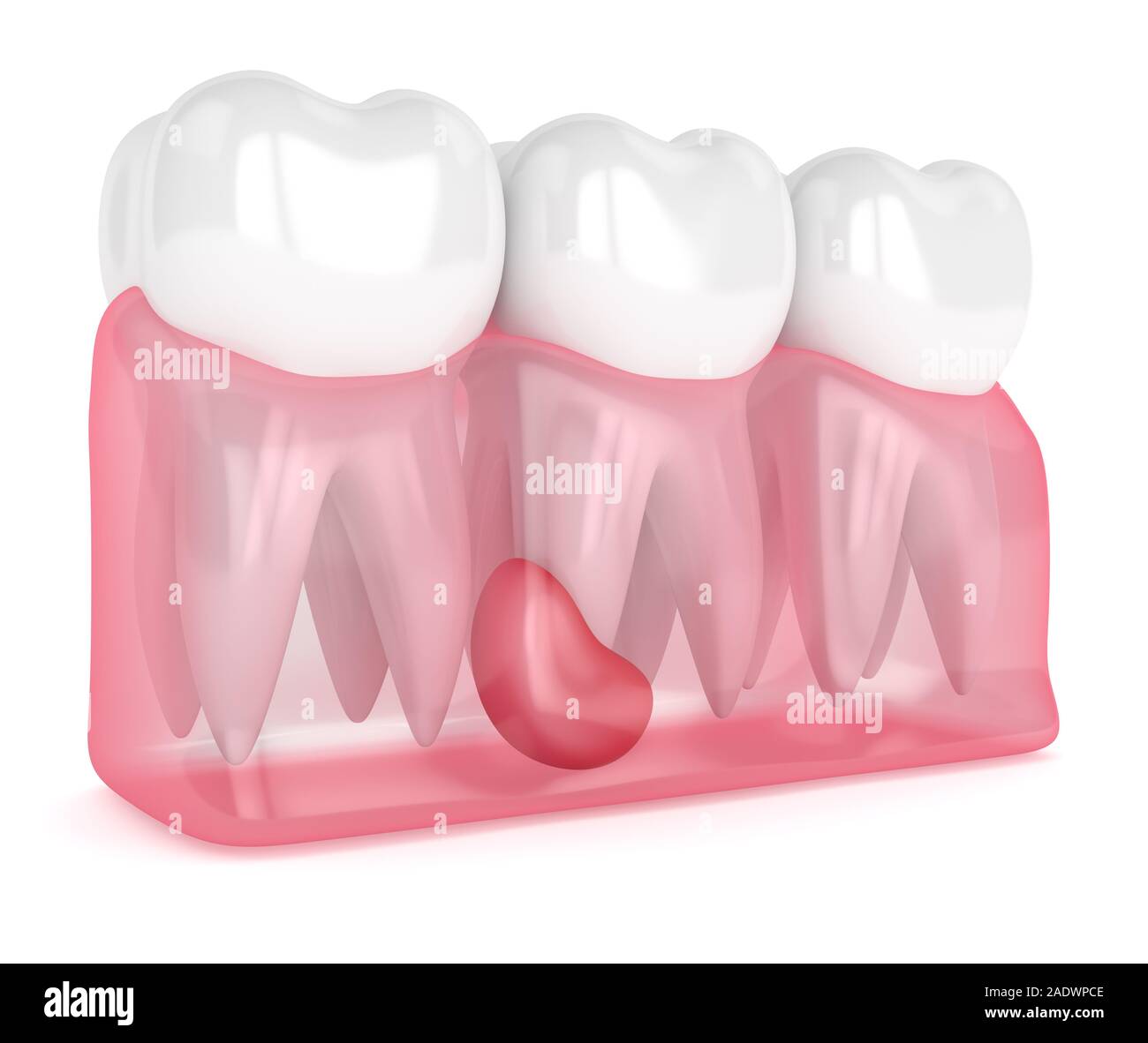 3d render of teeth in gums with cyst over white background. Dental ...