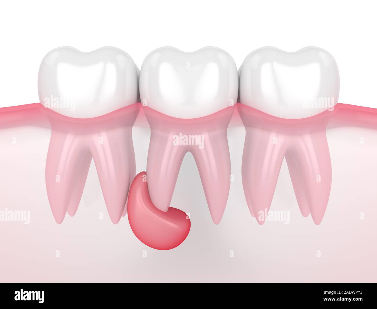 3d render of teeth in gums with cyst over white background. Dental ...