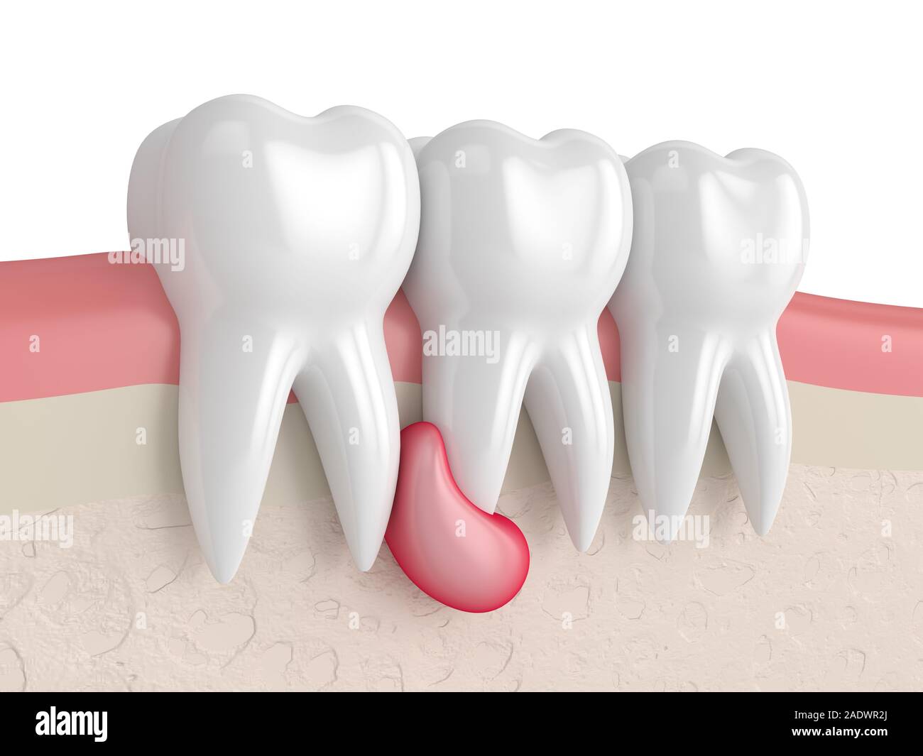 3d render of teeth in gums with cyst over white background. Dental ...