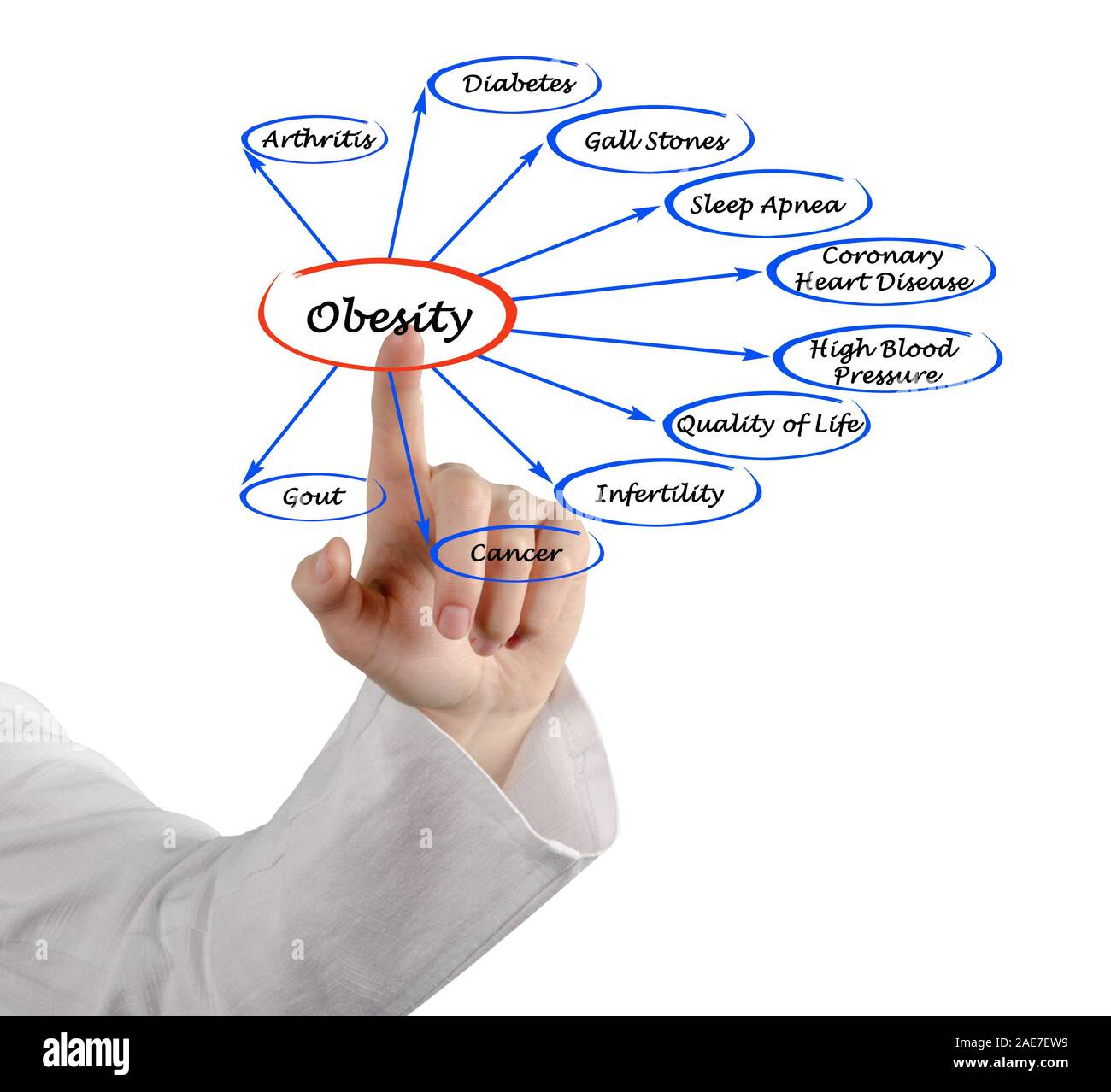 Diagram of Obesity Stock Photo - Alamy