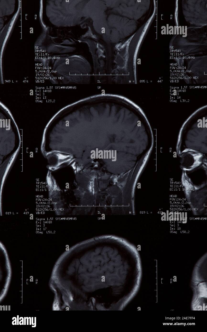 Human brain scan mri health hi-res stock photography and images - Alamy