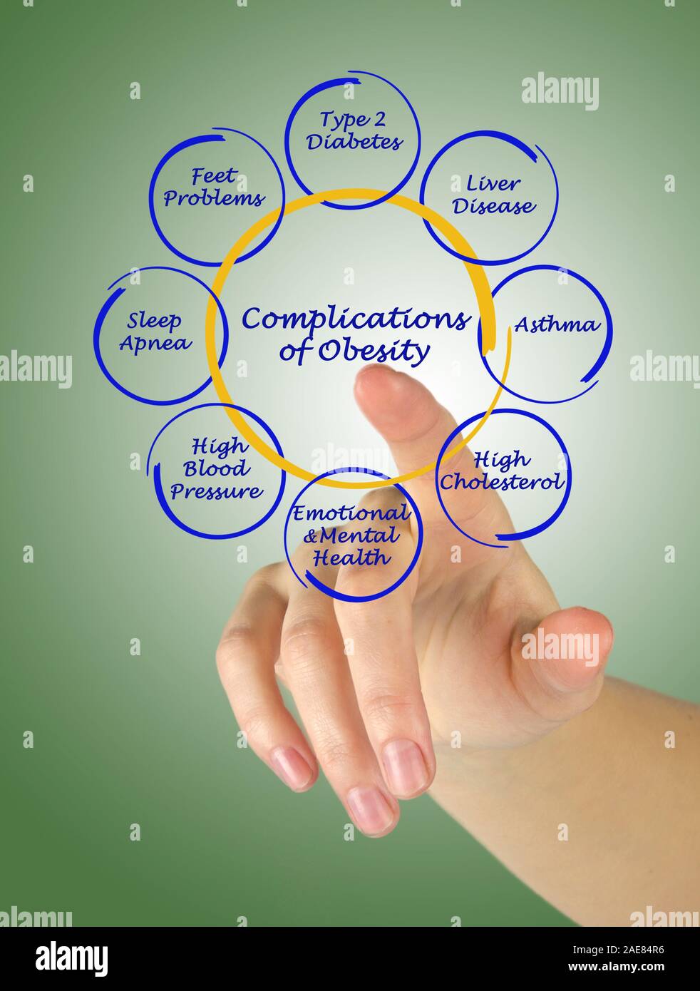 Medical complications of obesity hi-res stock photography and images ...
