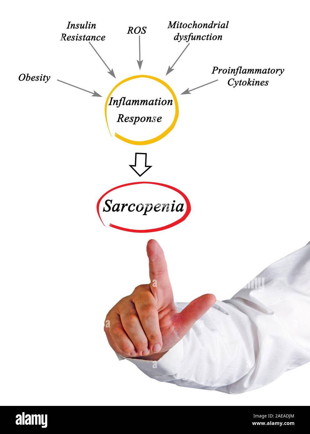 Causes of Sarcopenia Stock Photo - Alamy