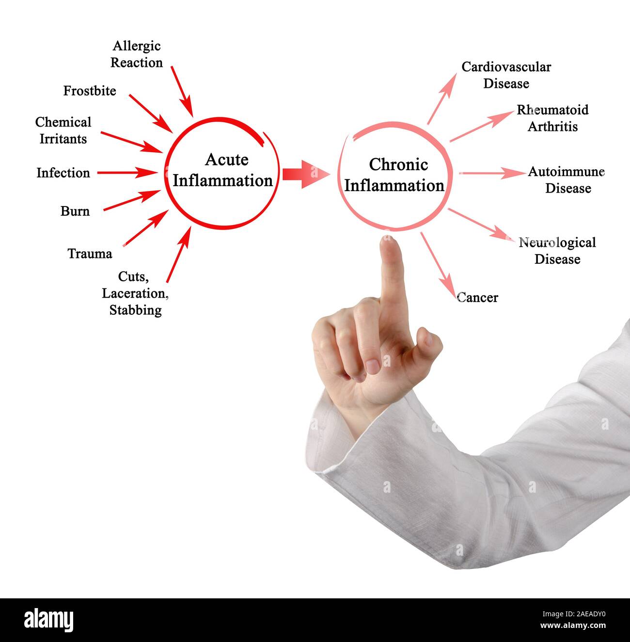 Acute and Chronic Inflammation Stock Photo - Alamy