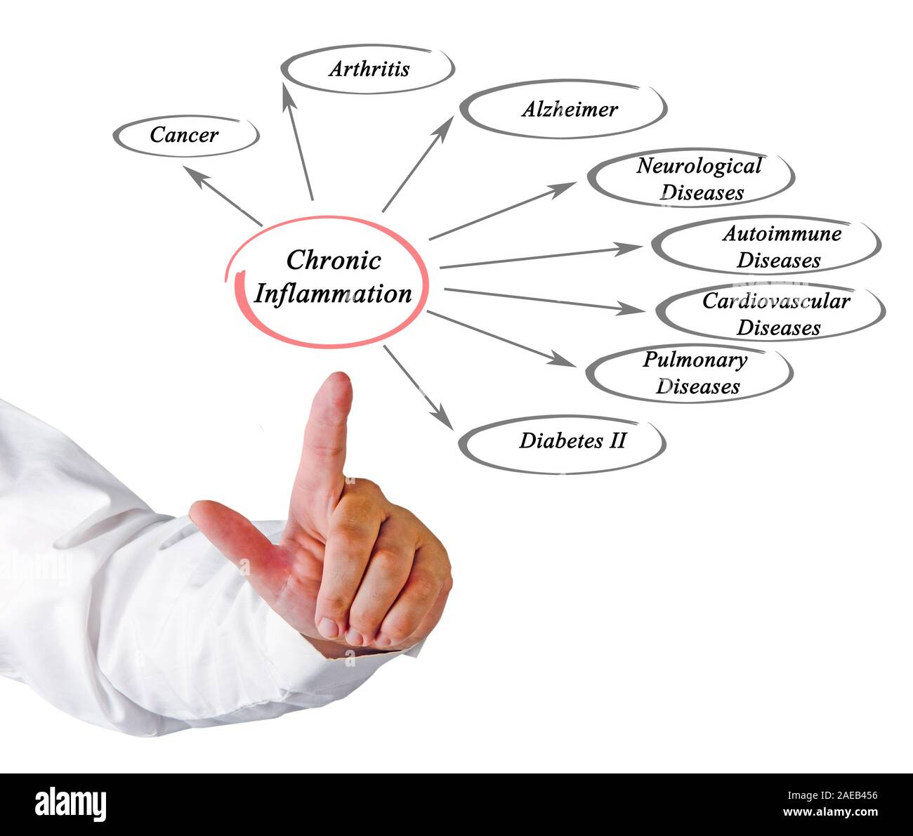 Inflammation pulmonary Cut Out Stock Images & Pictures - Alamy