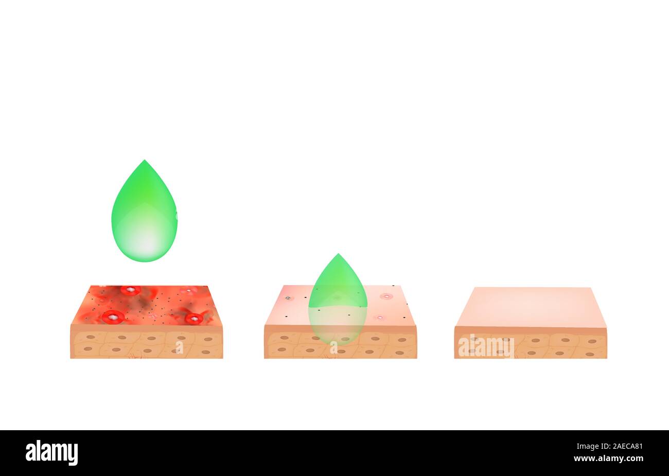 peeling for acne. Inflamed skin acne. Acne purulent. The anatomical ...
