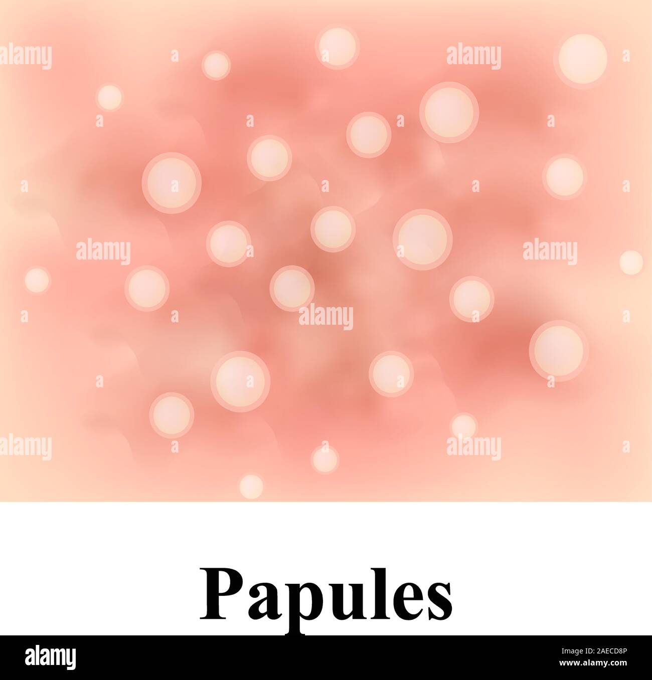 Papules on the skin. Acne. Pimples on the skin. Infographics. Vector ...