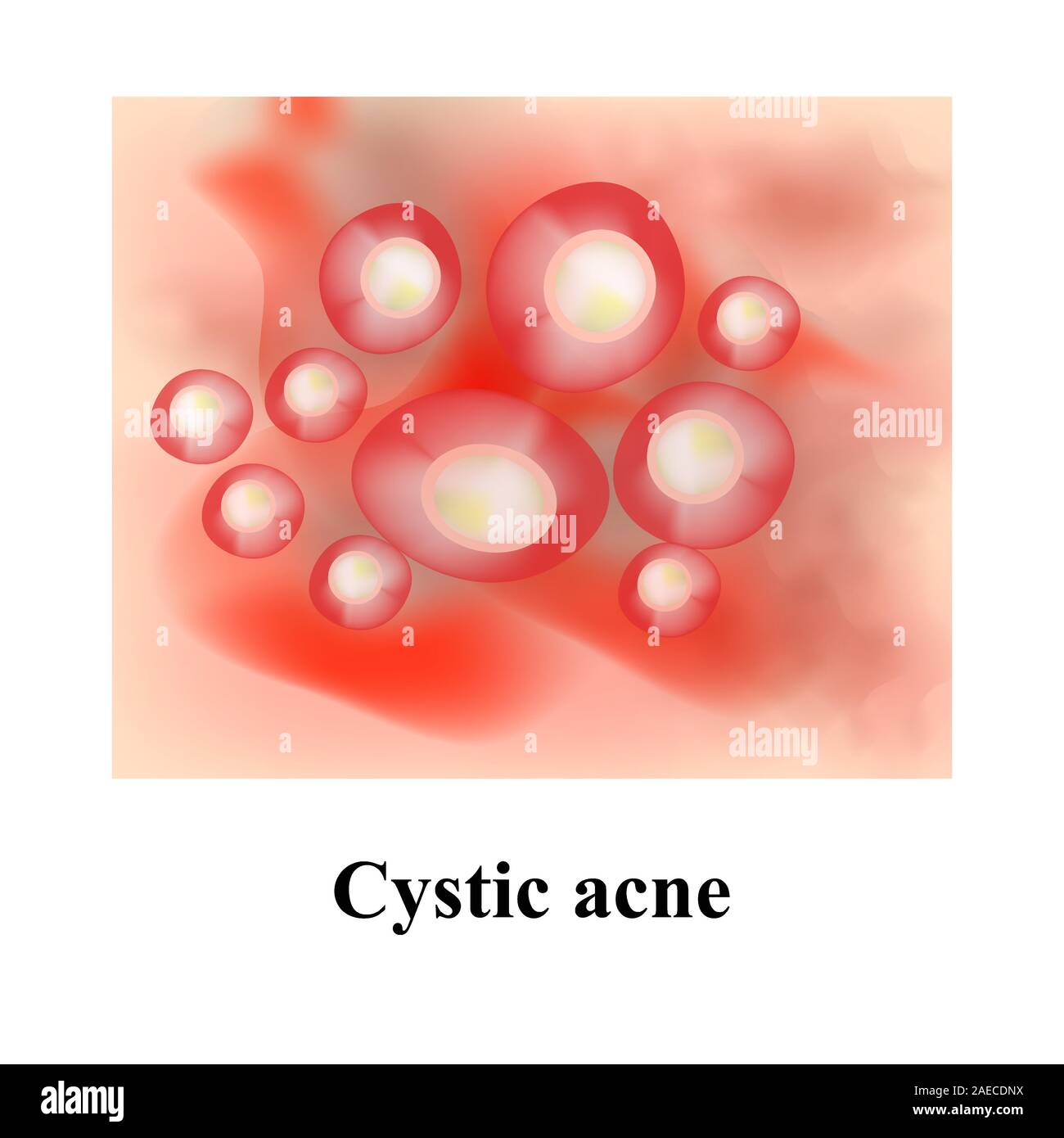 Pustules on the skin. Cystic acne. Pimples on the skin. Infographics ...