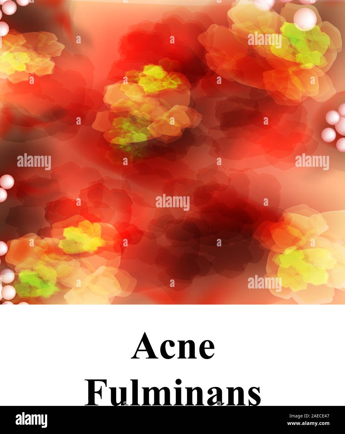 Pustules on the skin. Acne Fulminans. Cystic acne. Pimples on the skin ...