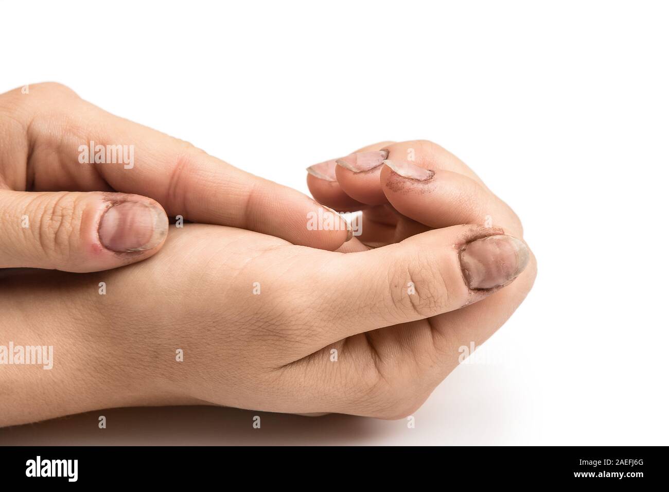 Dirty nails hi-res stock photography and images - Alamy