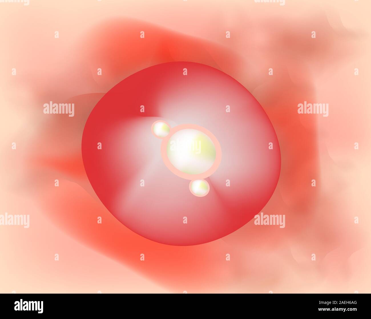 Pustules on the skin. Cystic acne. Pimples on the skin background ...