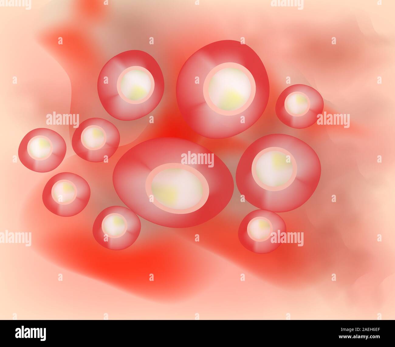 Pustules on the skin. Cystic acne. Pimples on the skin background. Acne ...