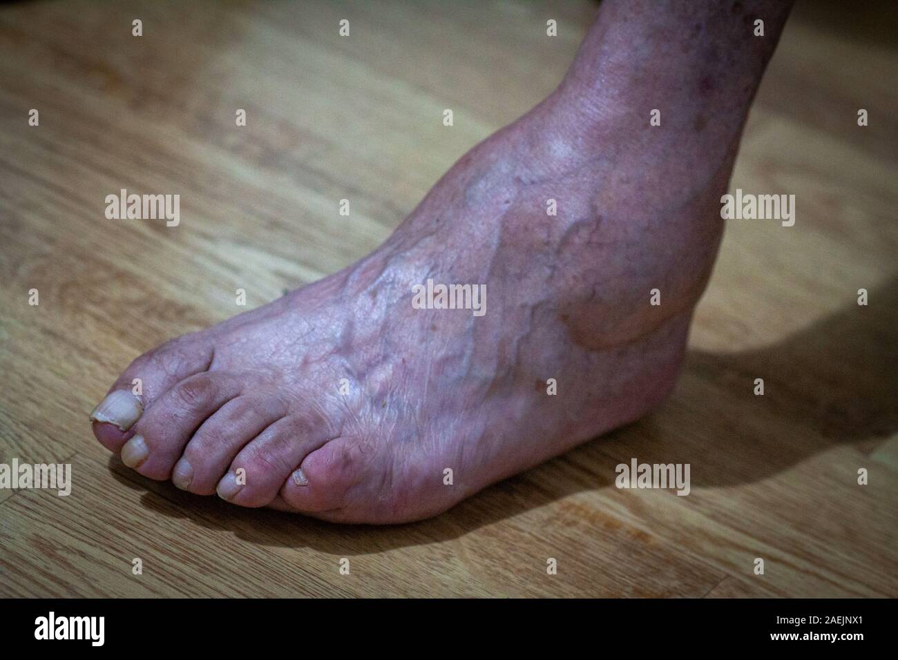 closeup feet of old man suffering from leprosy with a cane on the ...