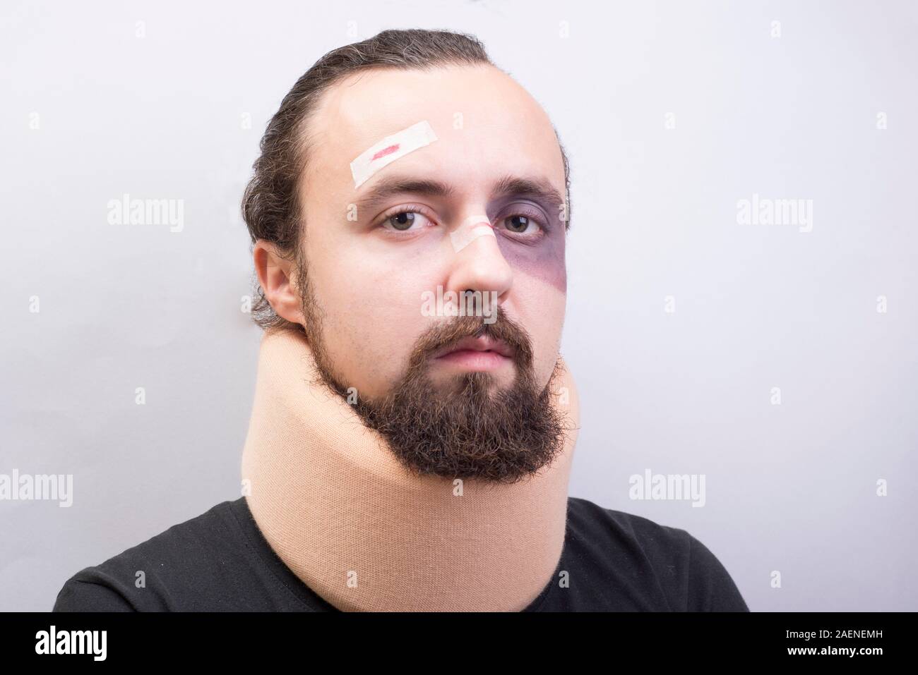 Strangled Neck Bruises