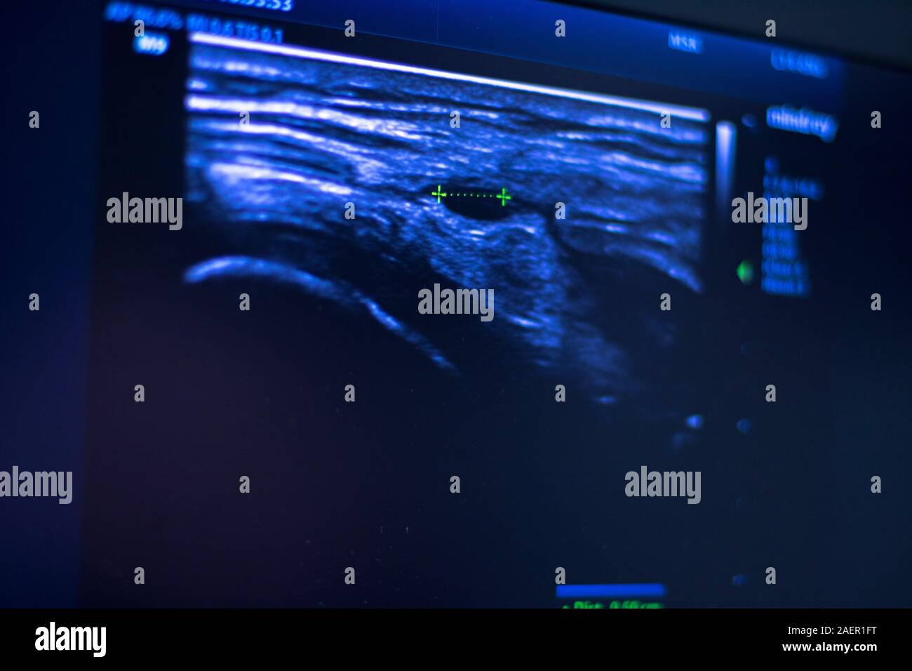 EPI Intratissue Percutaneous Electrolysis dry needling ultrasound ecography scan physiotherapy ...