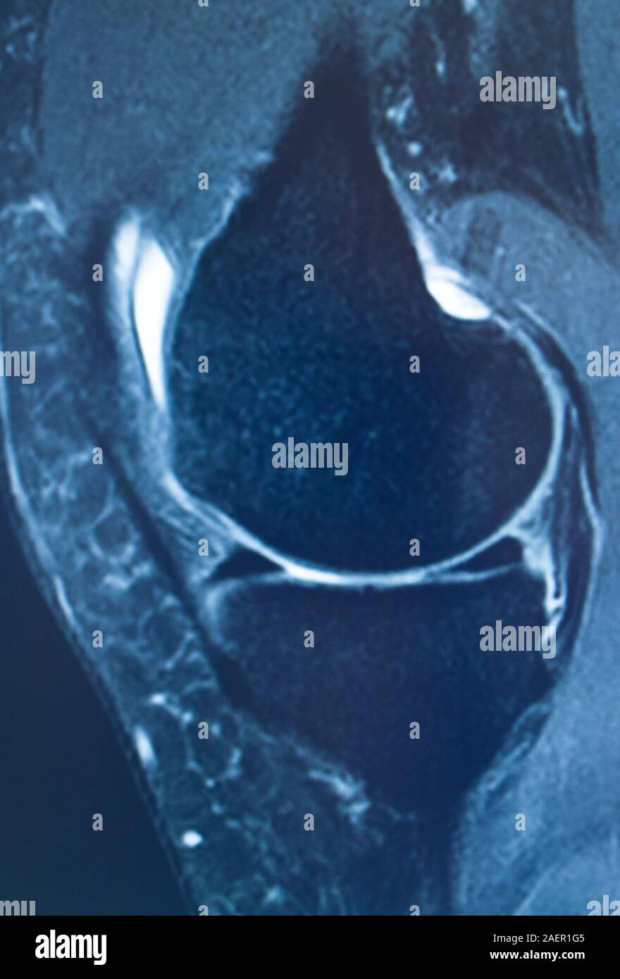 Knee sports injury mri mcl grade 2 tear magnetic resonance imaging ...