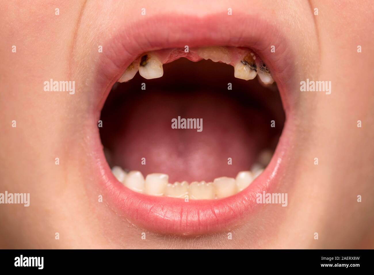 Rotten teeth child hi-res stock photography and images - Alamy