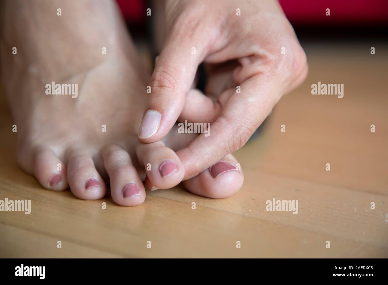 Toe Bale disease, malposition of the foot, hallux valgus , woman with ...