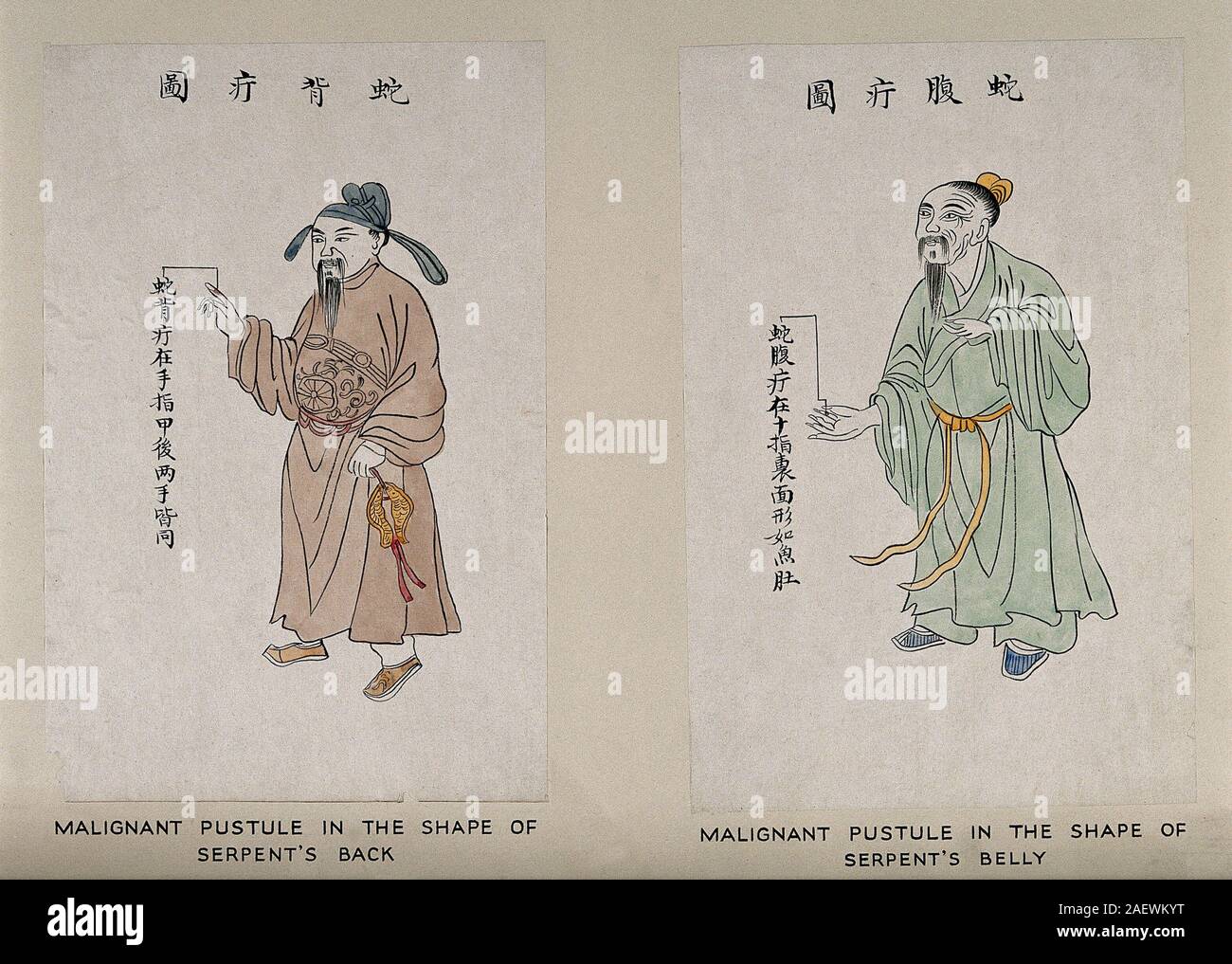 Malignant pustule hi-res stock photography and images - Alamy