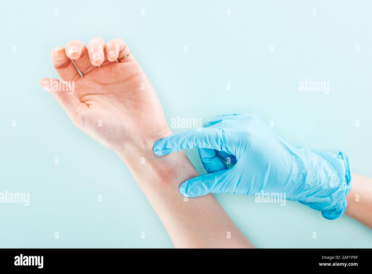 Patient allergic reaction hi-res stock photography and images - Alamy