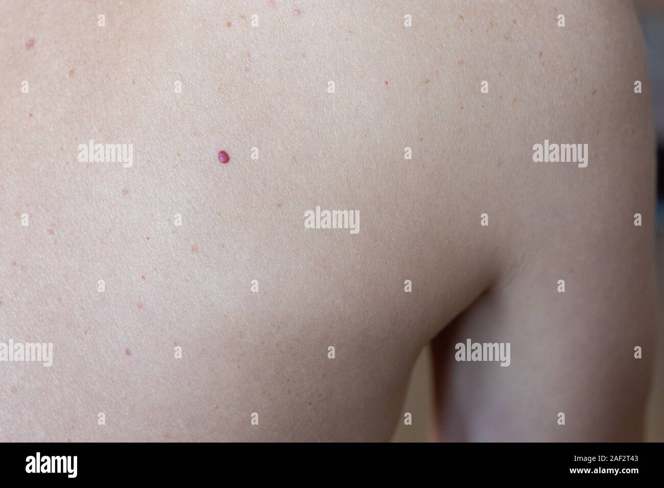 angioma. red mole on the back. rupture of a capillary vessel Stock ...