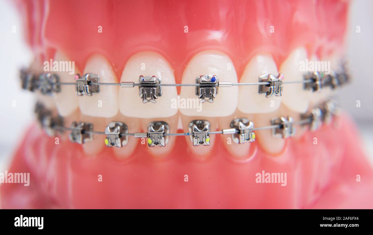 macro photography shows how the braces are arranged Stock Photo - Alamy