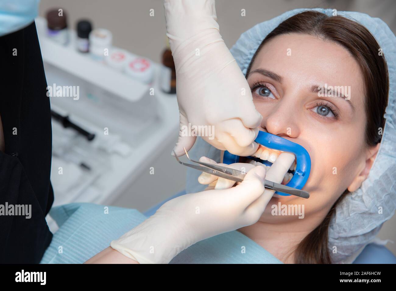 there is a preparation of the oral cavity to bleaching with the help of ...