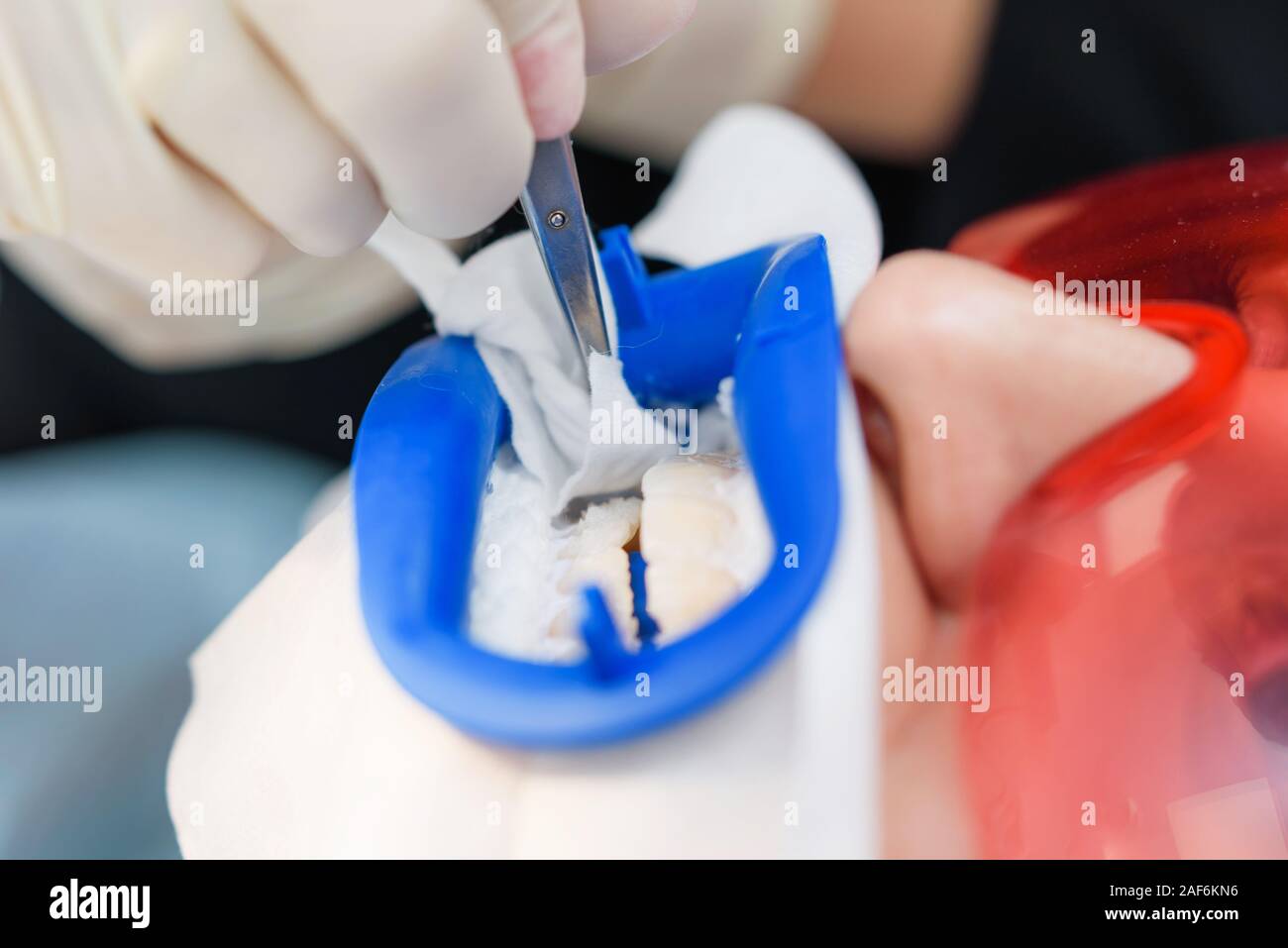 there is a preparation of the oral cavity to bleaching with the help of ...