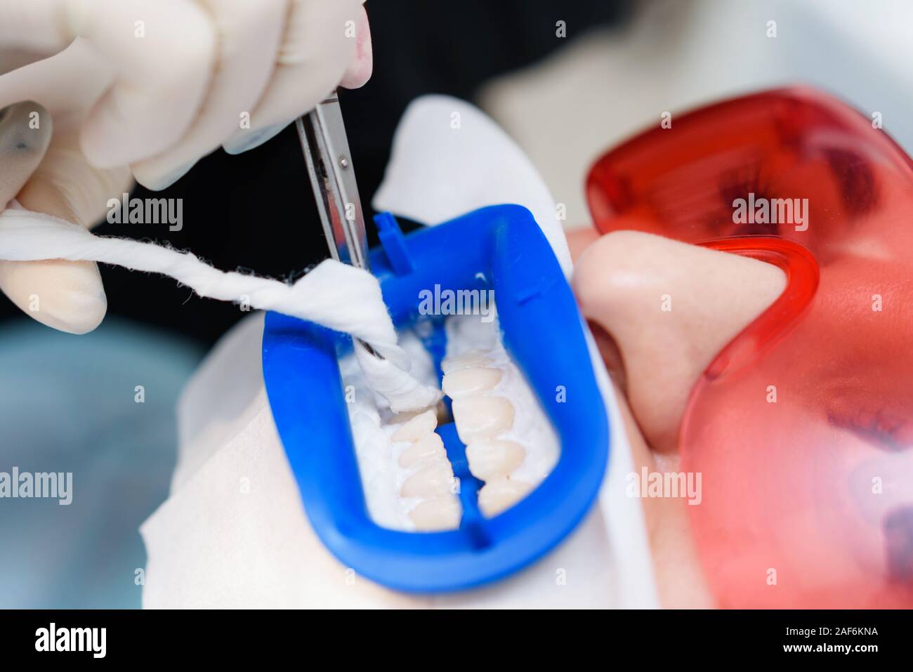 there is a preparation of the oral cavity to bleaching with the help of ...