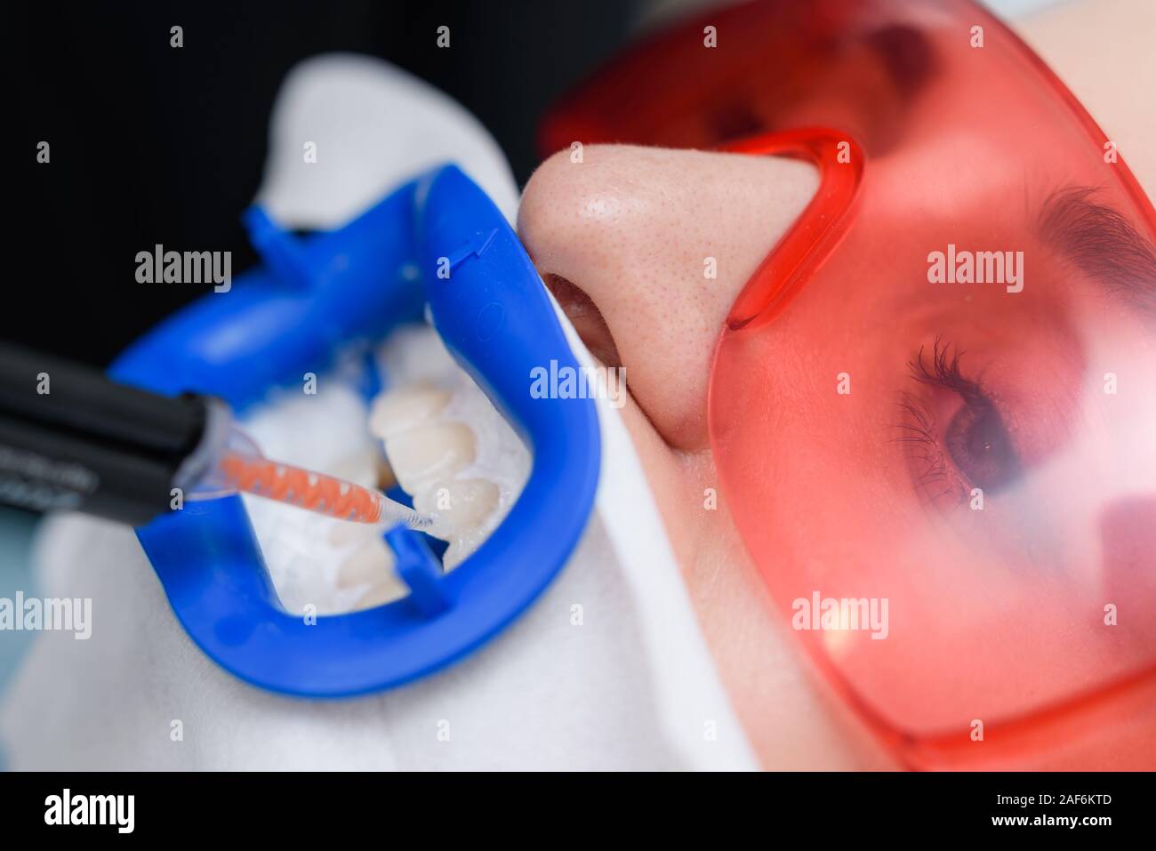 there is a preparation of the oral cavity to bleaching with the help of ...