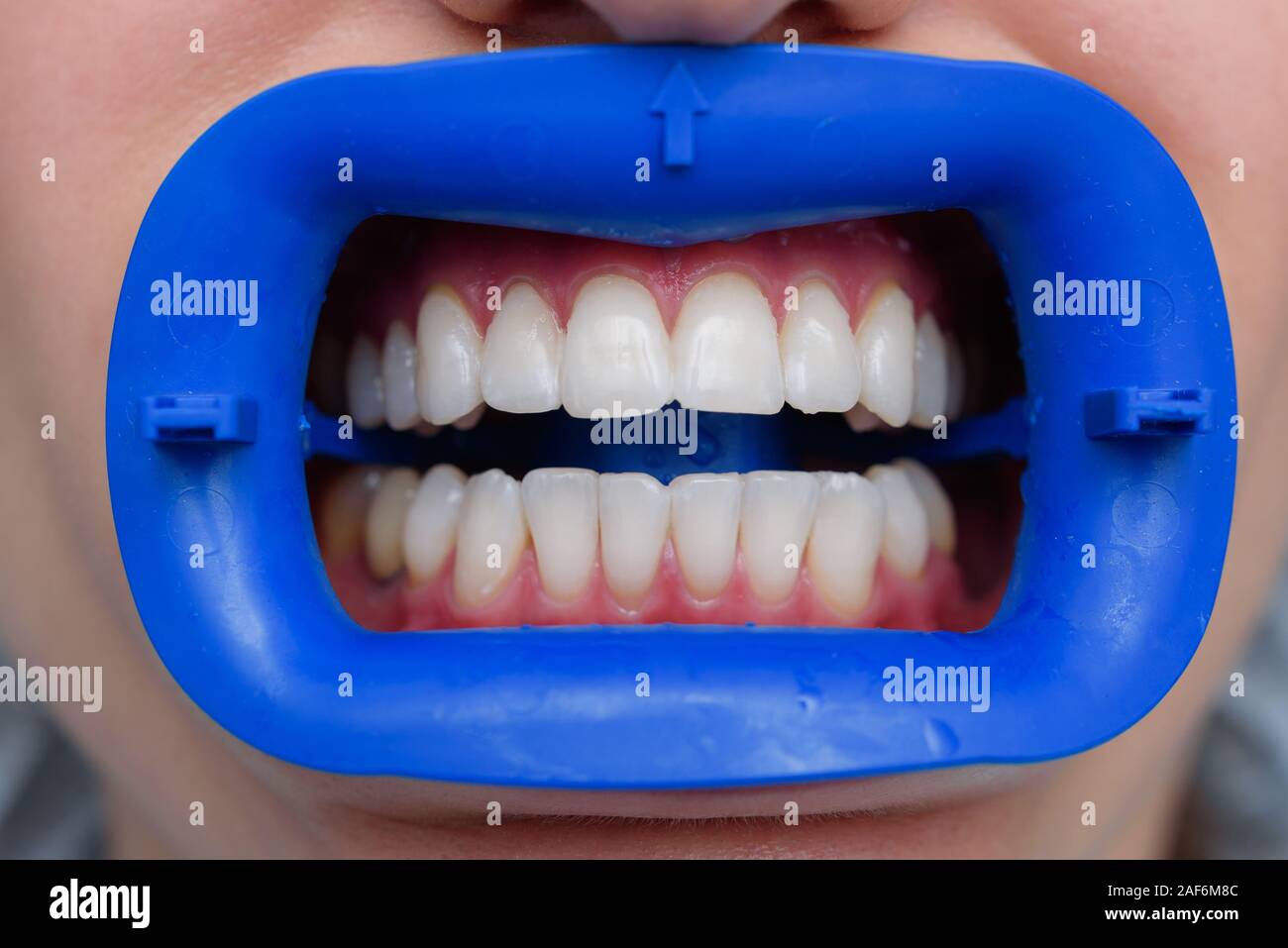 procedure for comparing the color shades of teeth after bleaching Stock ...