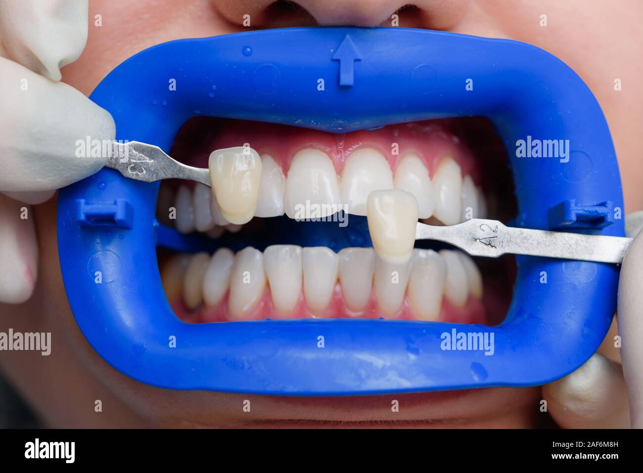 procedure for comparing the color shades of teeth after bleaching Stock ...