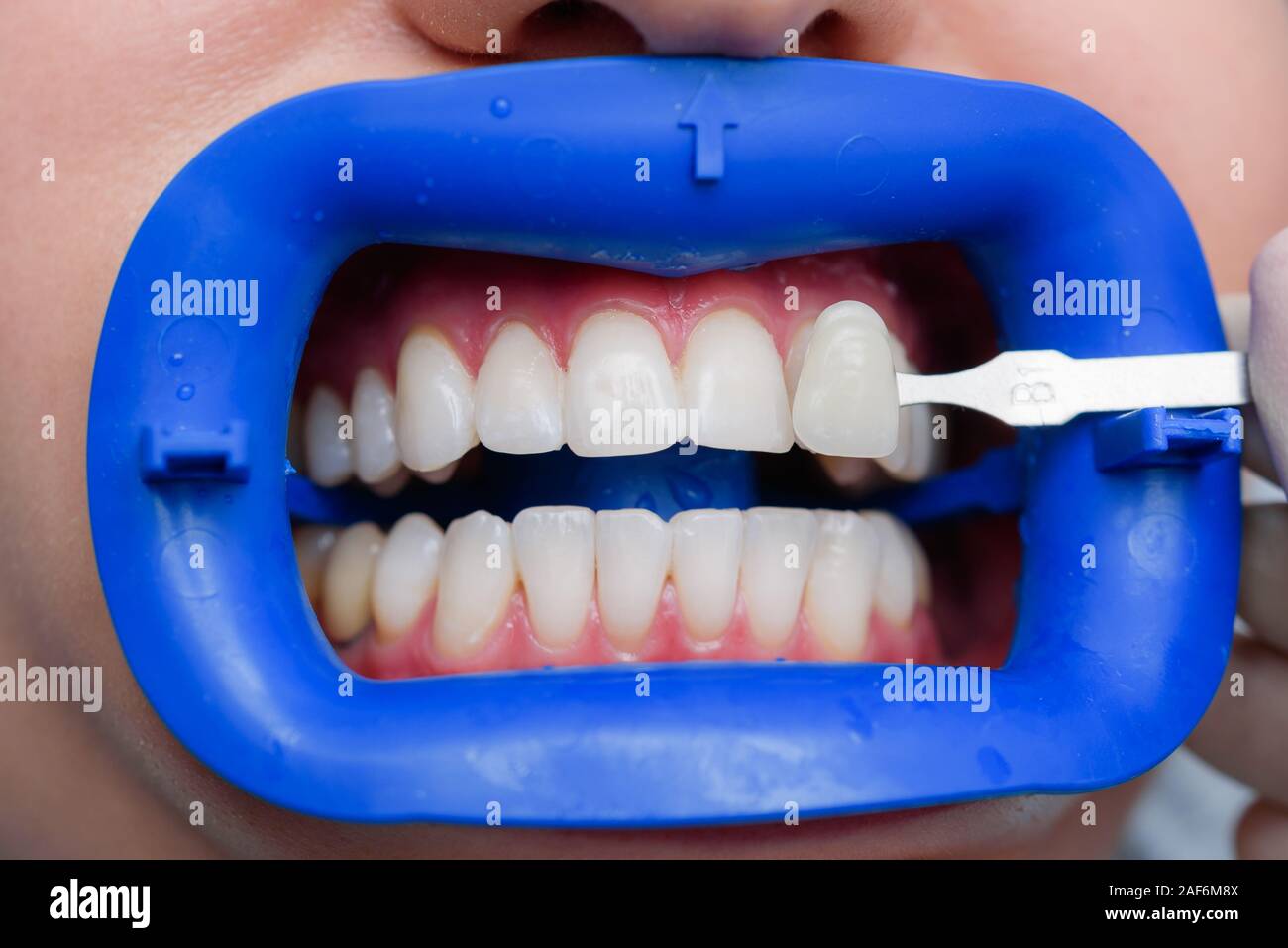 procedure for comparing the color shades of teeth after bleaching Stock ...