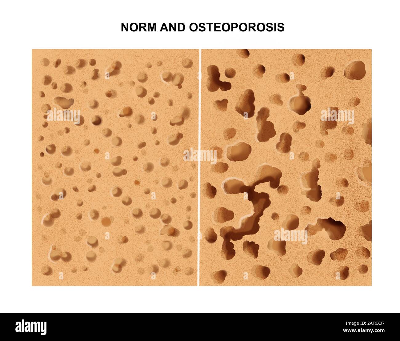 illustration of the Process of osteoporosis Stock Photo - Alamy