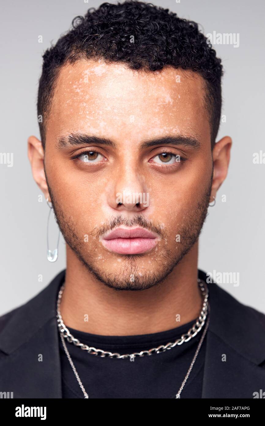 Studio Portrait Of Young Man With Skin Pigmentation Disorder Looking At ...