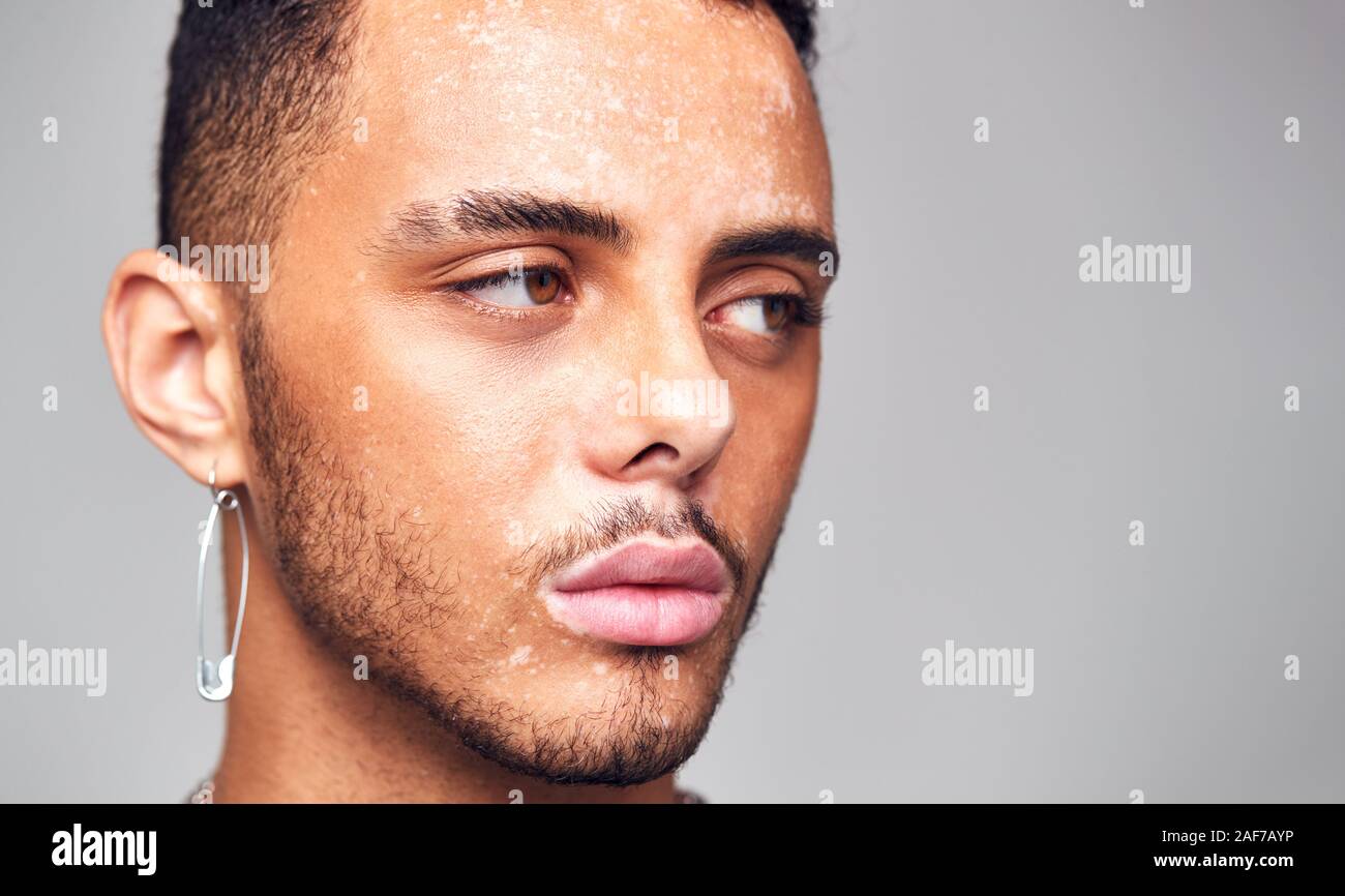 Thoughtful Young Man With Skin Pigmentation Disorder Looking Off Camera ...