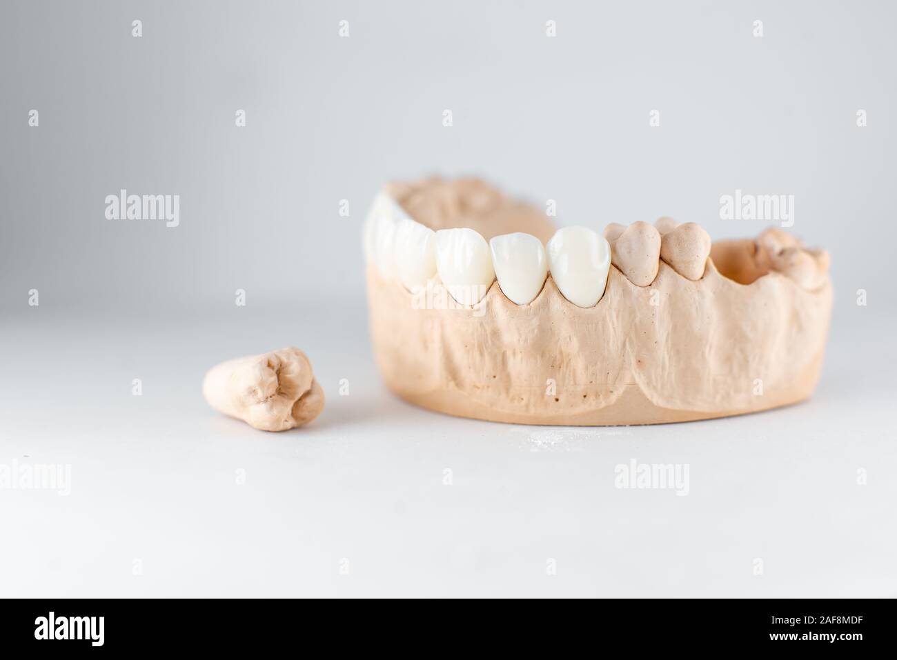 Close-up on plaster model of artificial jaw with veneers and tooth on ...