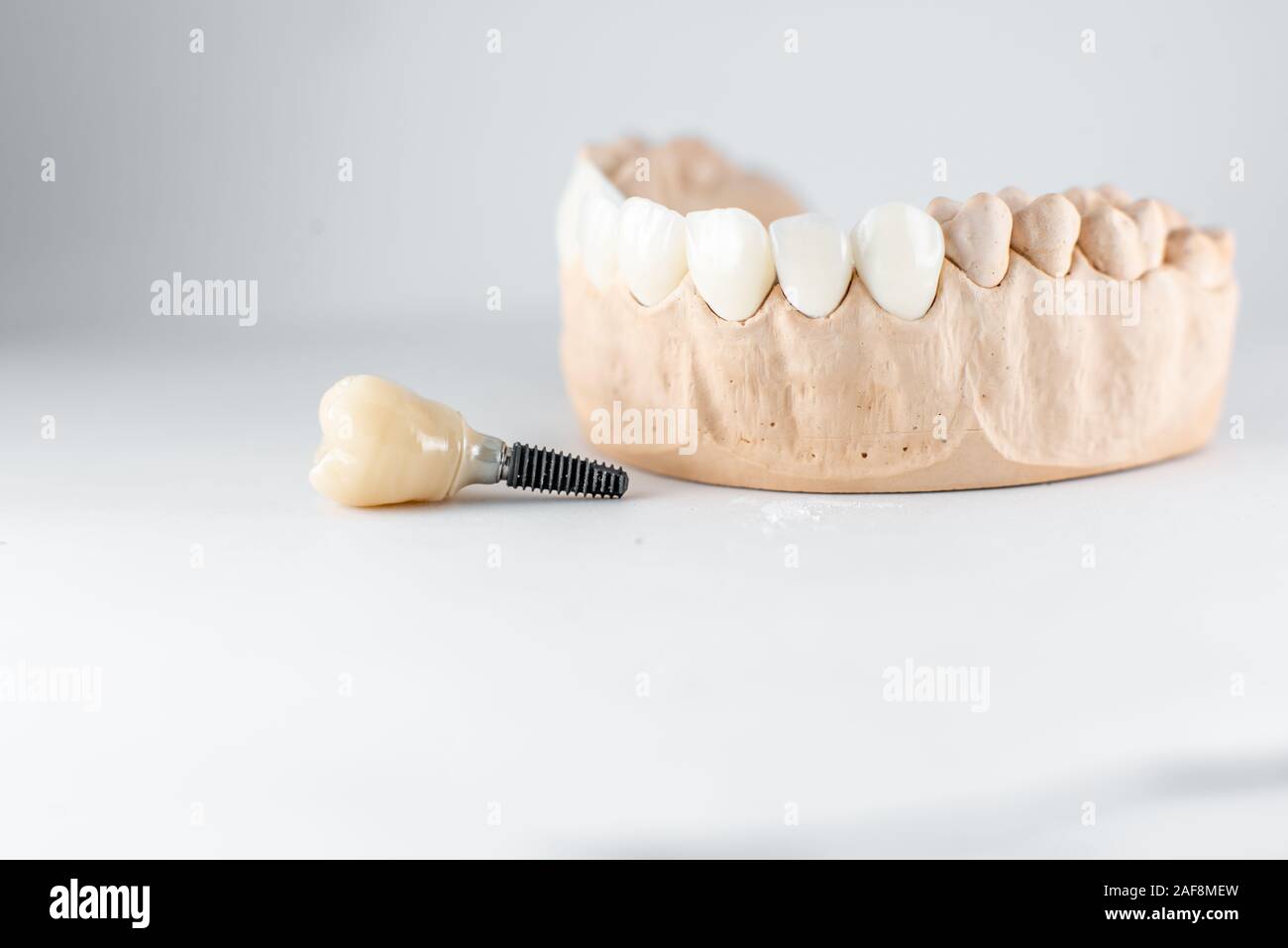 Close-up on plaster model of artificial jaw and dental implant on the ...