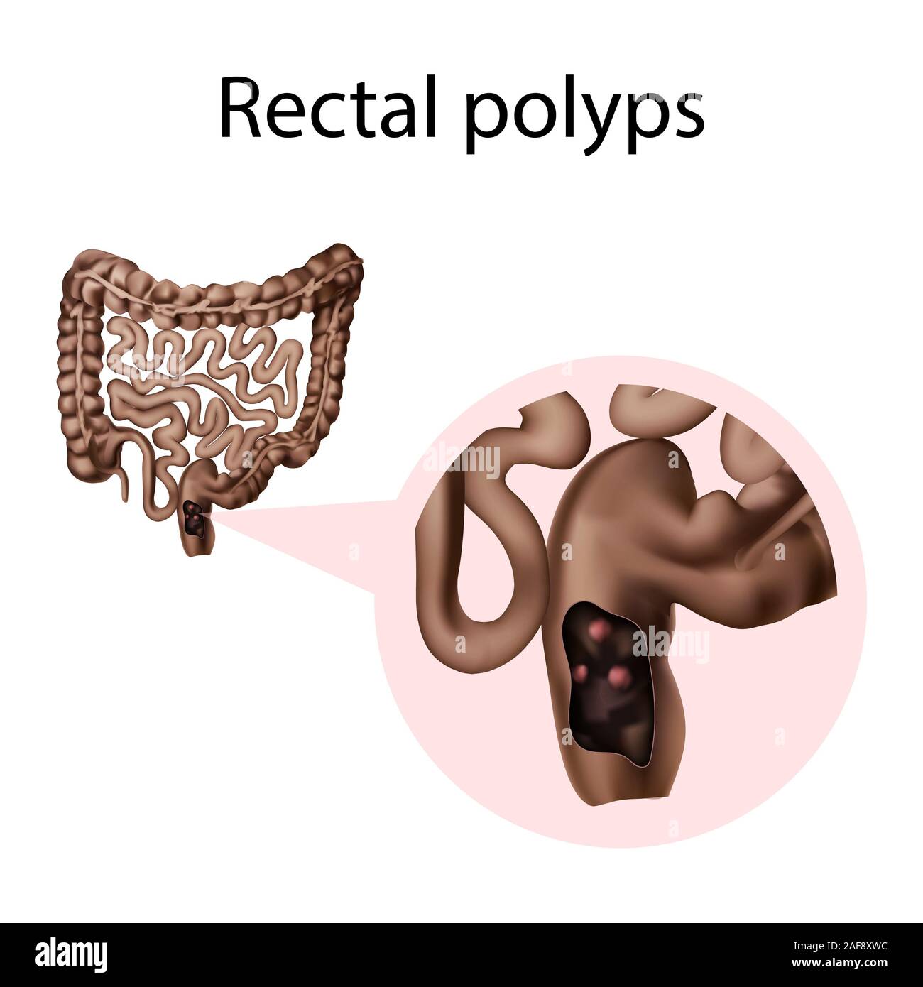 Rectal polyps, illustration Stock Photo - Alamy