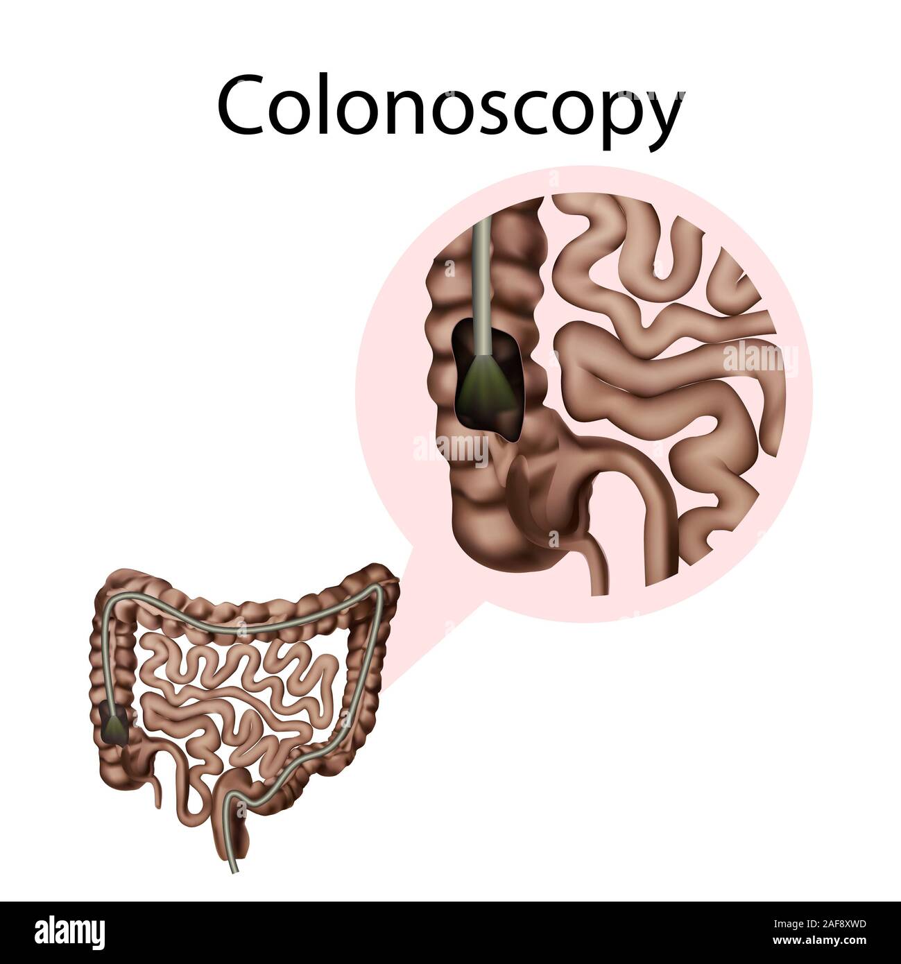 Large intestine endoscopy hi-res stock photography and images - Alamy