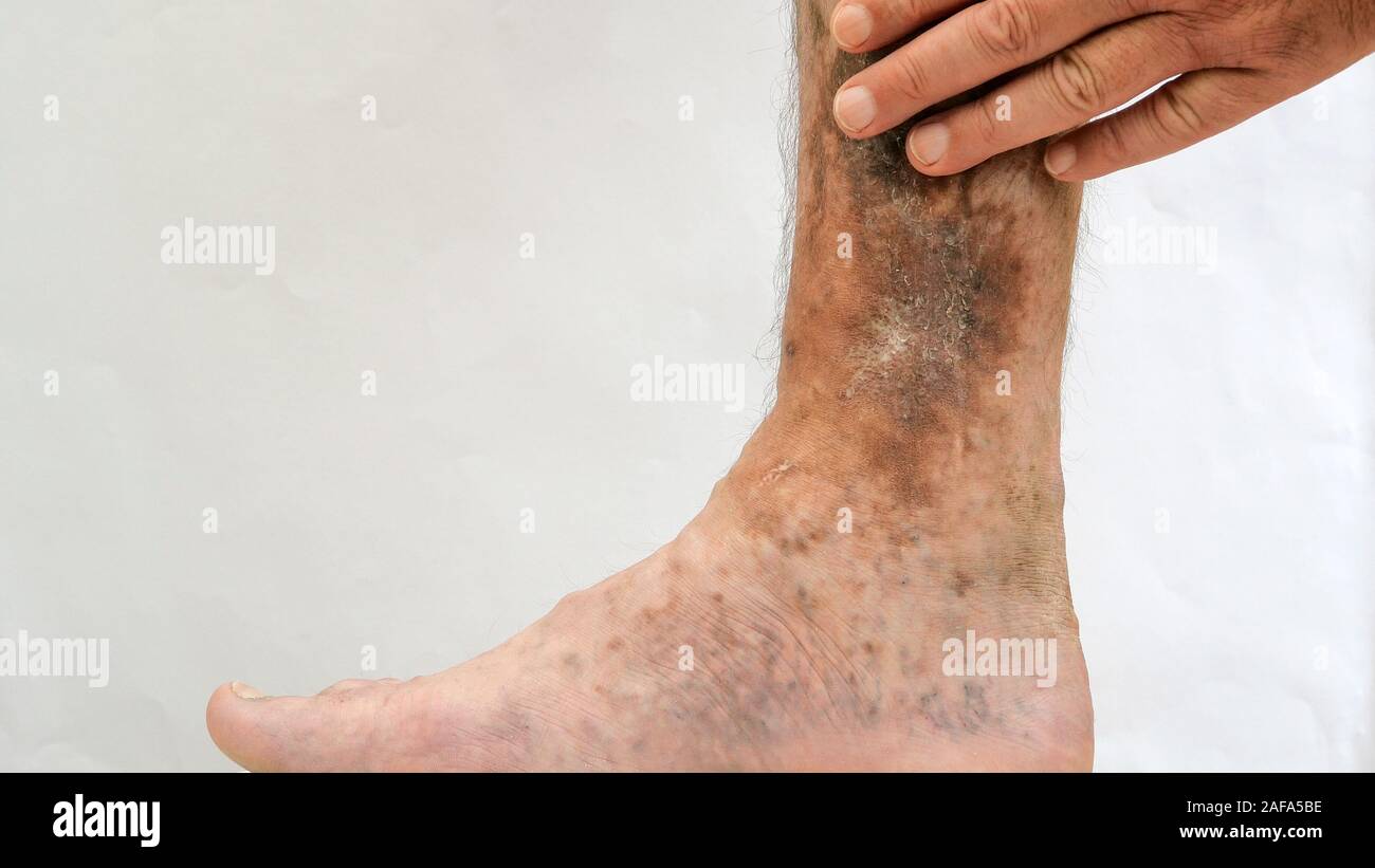 Illness of the human skin. Person s hands touch scars, ulcers, peeling ...