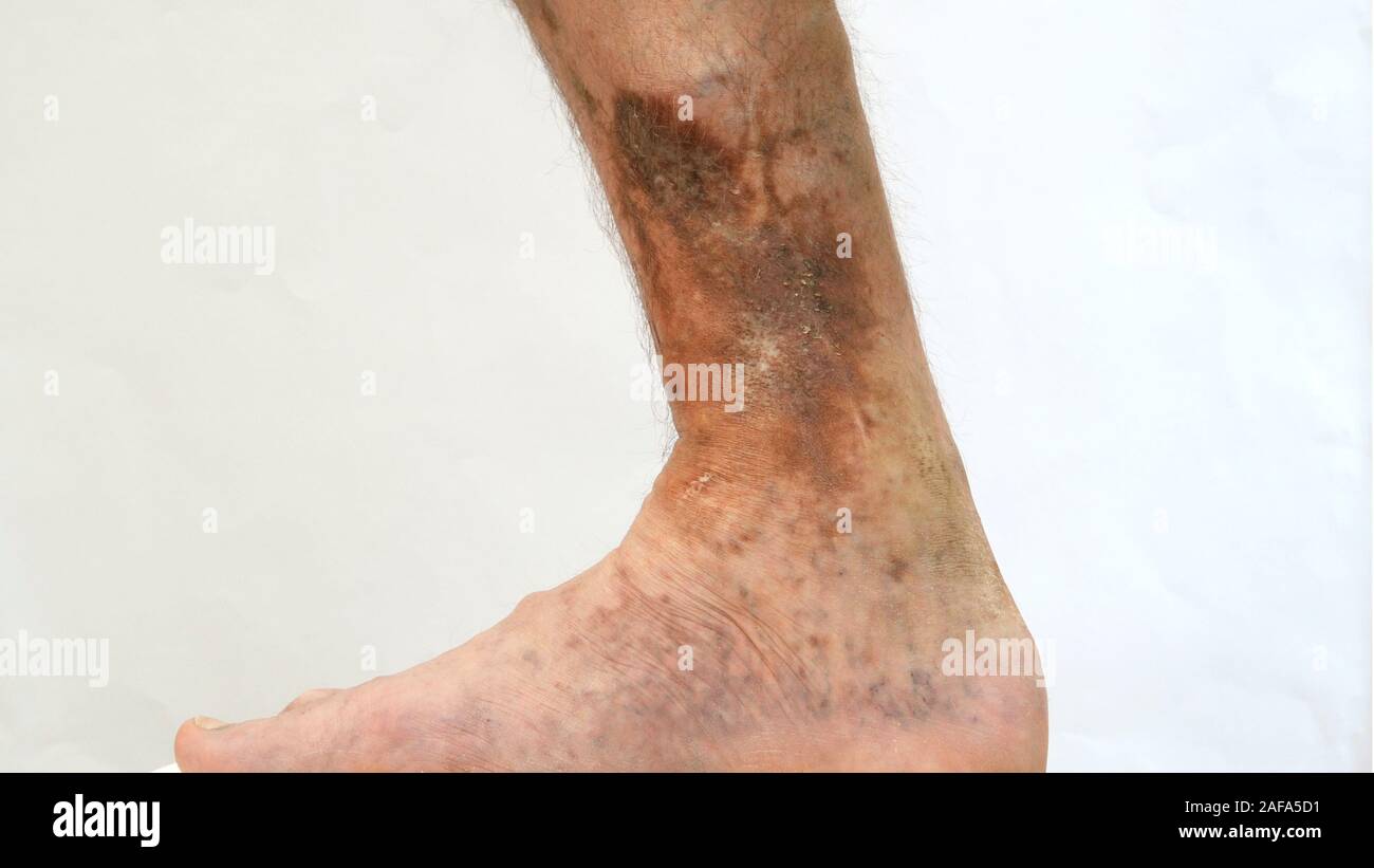 Human skin disease. Person foot that is affected by dermatological skin ...