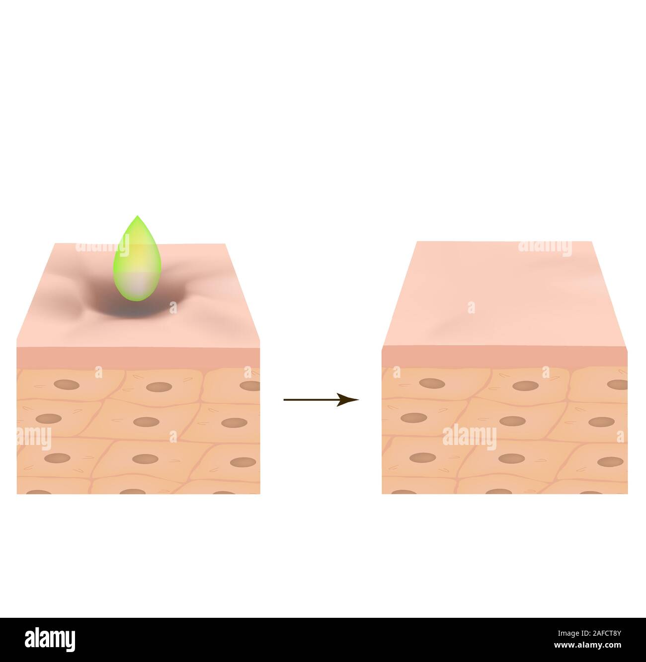 Acne scars. Acid peeling scar atrophic treatment. The anatomical ...
