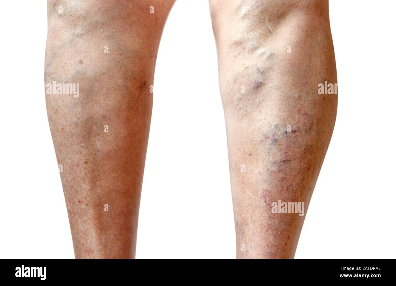 Varicose veins on a female legs. Phlebology Stock Photo - Alamy