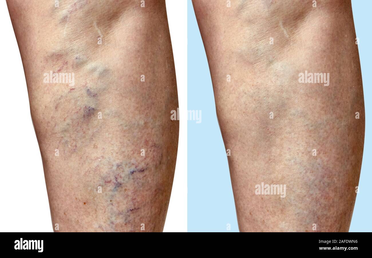 Varicose veins on a female legs. Phlebology Stock Photo - Alamy