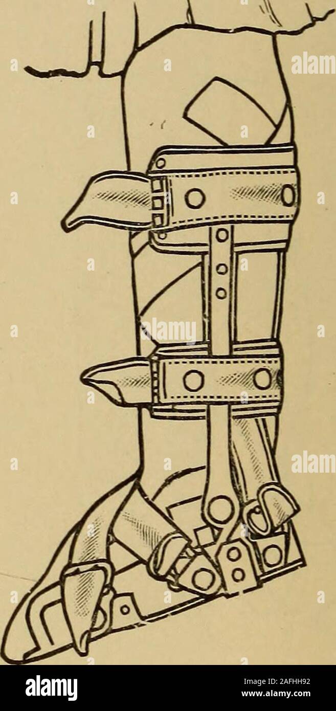 Club foot brace hi-res stock photography and images - Alamy